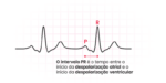 Intervalo PR: saiba o que é e sua importância para diagnósticos no ECG ...