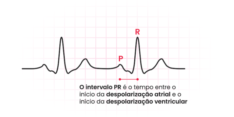 Intervalo PR: saiba o que é e sua importância para diagnósticos no ECG ...